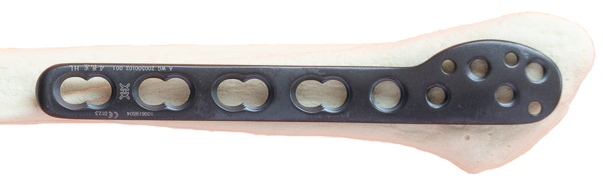 Distal Fibula Plates | Equinox Medical