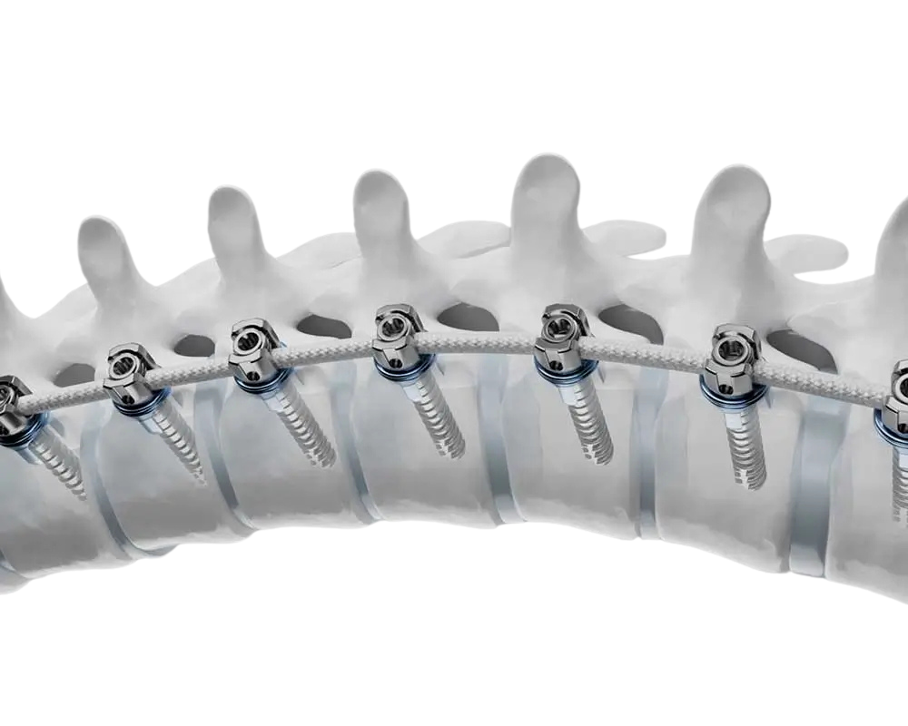 The Tether™ Vertebral Body Tethering System | Equinox Medical